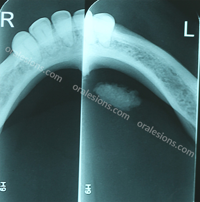 A 55-year-old woman with unilateral swelling of sublingual fold ...